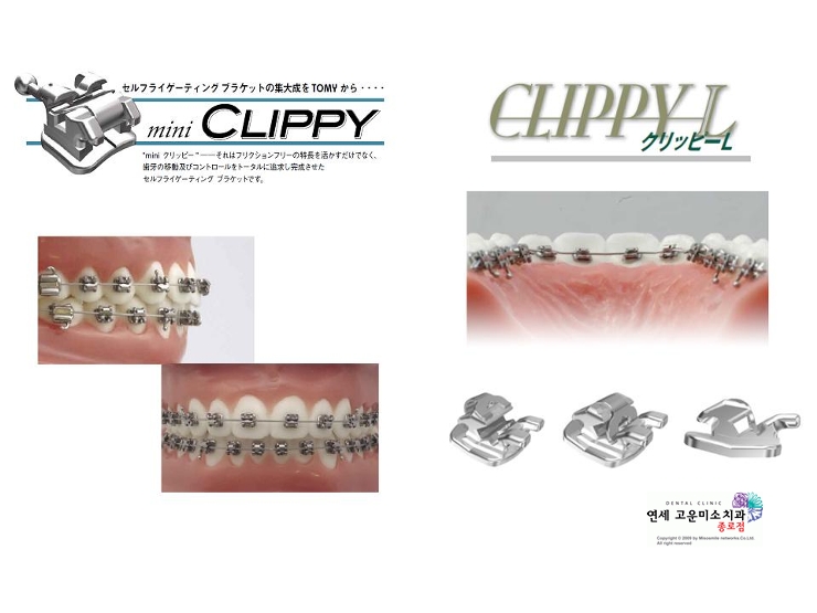 심미적 자가결찰 세라믹 장치인 클리피씨(Clippy-C) 브라켓 : 네이버 블로그