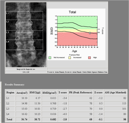 BMD(골밀도검사 Bone mineral densitometry)결과의 해석 : 네이버 블로그