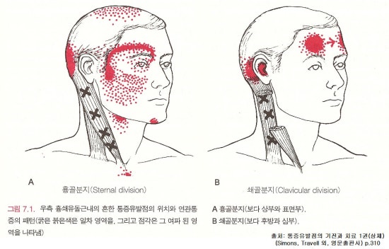 흉쇄유돌근 목빗근 Sternocleidomastoid Muscle Scm Muscle 래인보우한의원근육클리닉