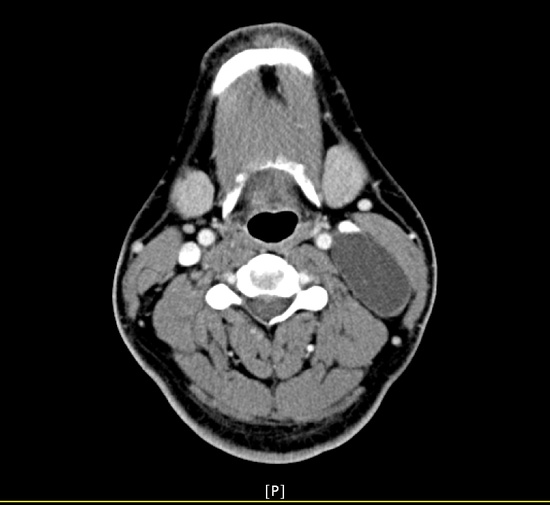 branchial cleft cyst : 네이버 블로그