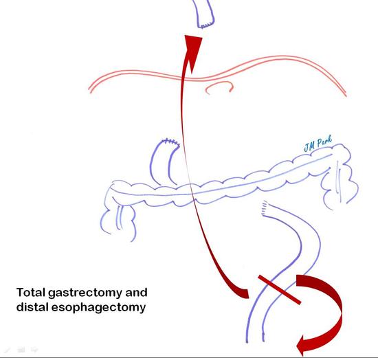 Roux-en-Y esophagojejunostomy : 네이버 블로그