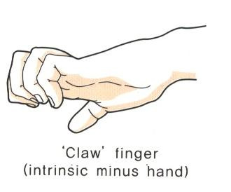 [배상의학] 수부신경손상에 의한 손의 변형 : 네이버 블로그