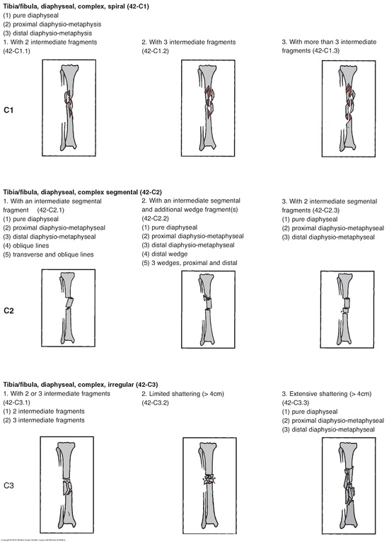 [Text] 경골 간부 골절 : Tibial Shaft Fracture by SungHun.Kim. : 네이버 블로그
