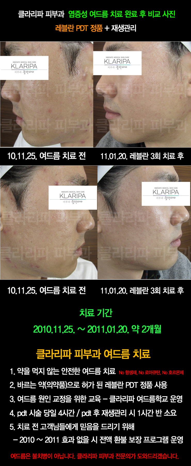 염증성 여드름 귀목턱부위 치료 전후 비교 사진 클라리파 피부과 레블란 Pdt 네이버 블로그