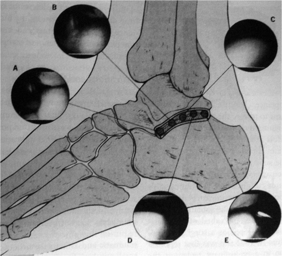 [ICL] Subtalar arthroscopy & A/S subtalar arthrodesis by SungHun.Kim ...
