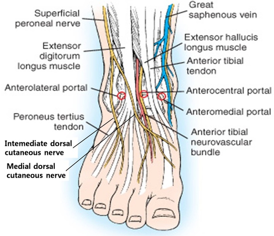 [Text] 족관절 관절경 : Ankle Arthroscopy by SungHun.Kim. : 네이버 블로그