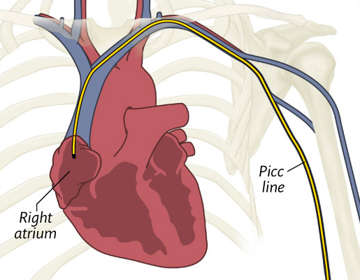 PICC : 네이버 블로그
