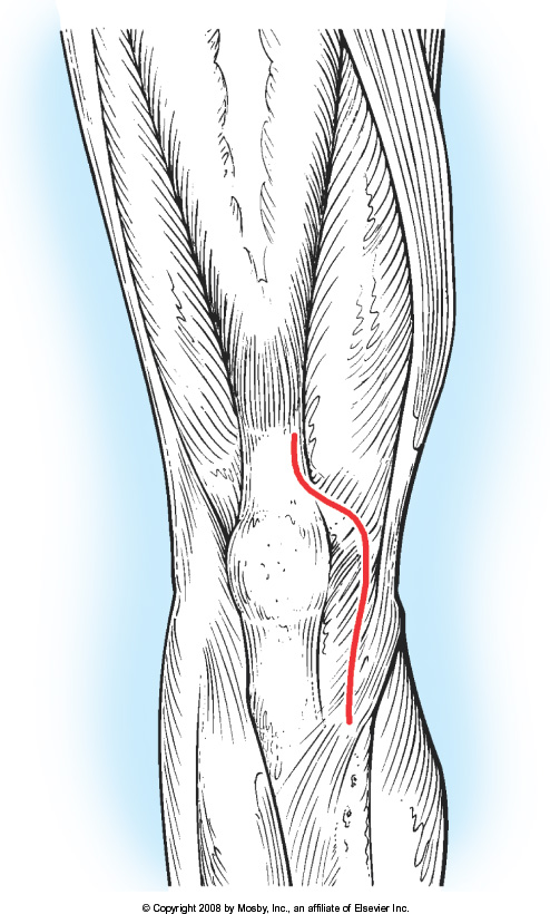 [Text] 슬관절 인공관절치환술 수술 술기 : Surgical Technique of Total Knee ...