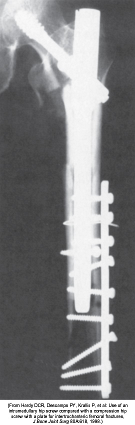 [Text] 대퇴골 전자간 골절 : Intertrochanteric Femur Fracture By SungHun.Kim ...