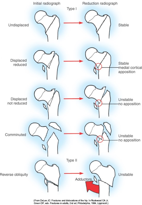 [Text] 대퇴골 전자간 골절 : Intertrochanteric Femur Fracture By SungHun.Kim ...