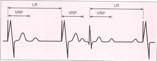 Pacemaker mode의 이해 (AAI, VVI, VDD, DDD) : 네이버 블로그