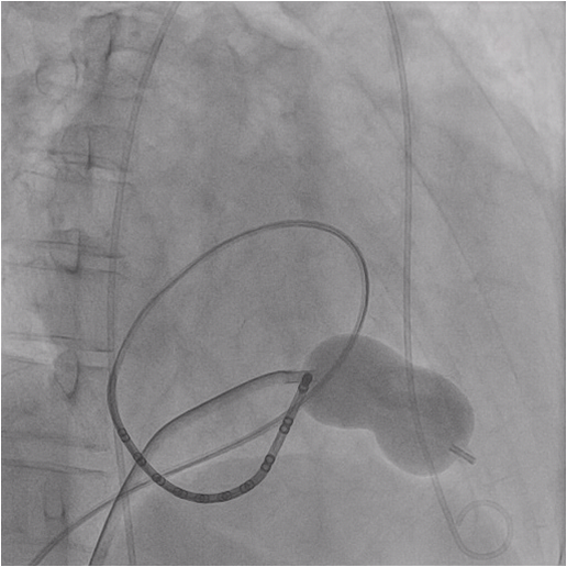 PMBV(경피적 승모판막 풍선 성형술)에 관하여 : 네이버 블로그