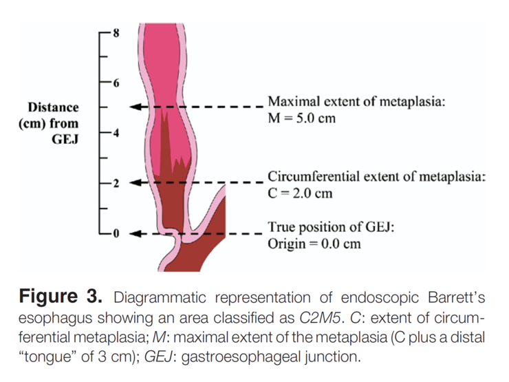 The Prague classification of Barrett esophagus : 네이버 블로그