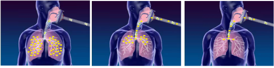 기침유발기(Mechanical In-Exsufflator) 이해하기 : 네이버 블로그