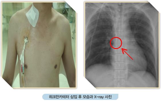 Hickman catheter (히크만카테터) : 네이버 블로그