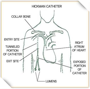 Hickman catheter (히크만카테터) : 네이버 블로그