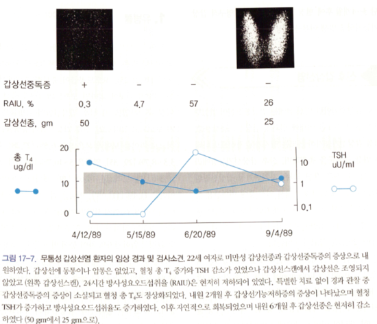 무통성 갑상선염아급성 림프구성 갑상선염 네이버 블로그