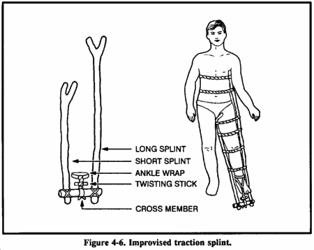Traction splint ( Thomas splint 넓다리뼈 당김부목, 대퇴골 견인부목) : 네이버 블로그