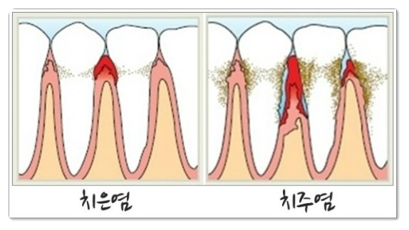 논현동치과 잇몸질환 우리 몸을 위협한다 잇몸질환치주질환치료치주염치은염 네이버 블로그