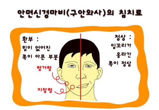 구안와사와사풍안면신경마비 자고 일어났더니 입이 돌아갔어요 구안와사와사풍안면신경마비대전 강남한의원 네이버 블로그