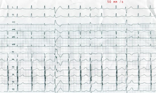 Ashman phenomenon /의학 블로그, 세균맨 : 네이버 블로그