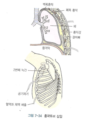 Chest Tube Drainage(CTD) or Water sealed thoracic drainage 흉곽배액 : 네이버 블로그
