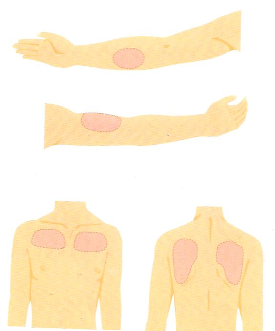 투약간호(비경구투여)-피내,피하,근육,정맥(ID,SC,IM,IV)intradermal injection, subcutaneous ...