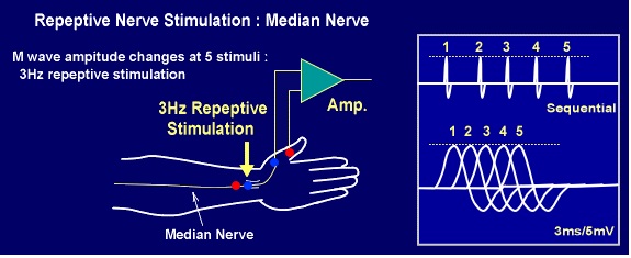 반복신경자극검사 Jolly test (Repeptive Stimulation) 개요 : 네이버 블로그