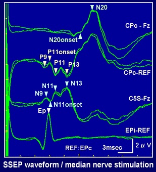 체성감각유발전위 - SSEP, Short latency Somatosensory Evoked Potential : 네이버 블로그