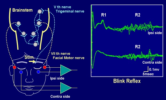 순목검사 Blink Reflex 개요 : 네이버 블로그
