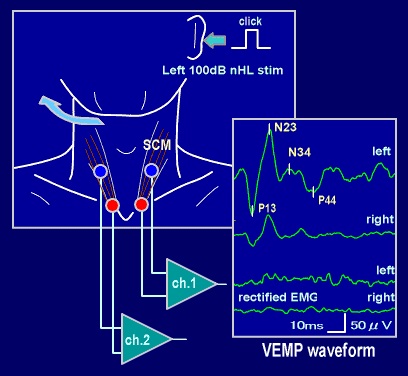 청각유발전위 - 전정유발근전위, VEMP, Vestibular Evoked Myogenic Potential : 네이버 블로그