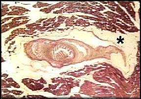 유구낭미충[ pork bladder worm , 有鉤囊尾蟲 , ゆうこうのうびちゅう ] : 네이버 블로그