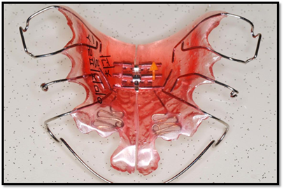 이플과 함께 알아보는 가철성 장치 ACTIVE PLATE(액티브 플레이트) 교정장치 : 네이버 블로그