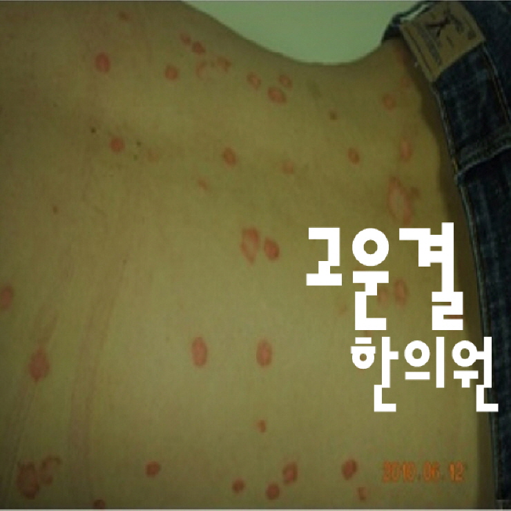 건선 피부염 원인과 건선 증상 사진 그리고 건선 치료방법 네이버 블로그