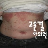 건선 피부염 원인과 건선 증상 사진 그리고 건선 치료방법 네이버 블로그
