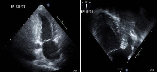 심장 정밀 검사 심장초음파 검사 2 경식도 심초음파 검사tee Transesophageal