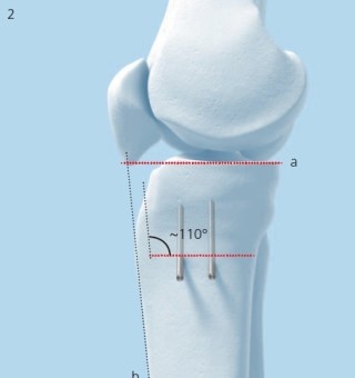 Open wedge HTO (Synthes Tomofix brochure) : 네이버 블로그