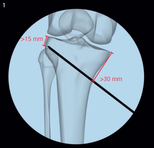 Open wedge HTO (Synthes Tomofix brochure) : 네이버 블로그