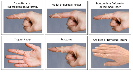 백조목 손가락 변형 (Swan Neck Deformity) 교정기_Oval-8® Finger Splints_백조목 ...
