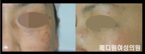 성남오타모반치료성남오타모반저렴한곳성남에브넘치료성남양측성오타모반성남후천성오타모반치료성남피부과 분당피부과 성남기미 분당기미