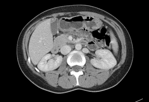 phrygian cap deformity gallbladder : 네이버 블로그
