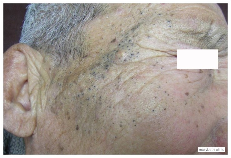 청주 피부과 여드름과 닮은 질환 16. 노인성 면포(Senile Comedones) : 네이버 블로그