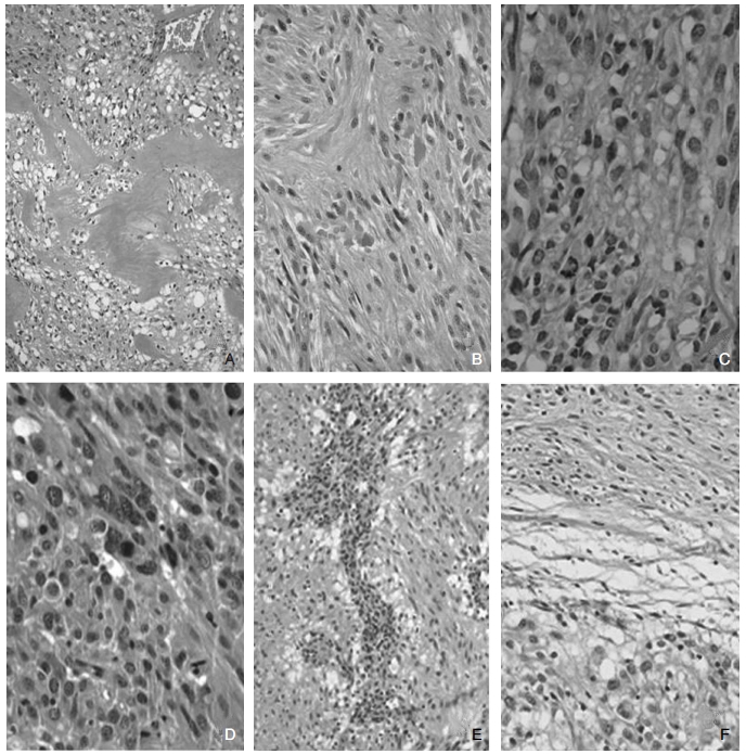 SET/GIST 진료지침 : 네이버 블로그