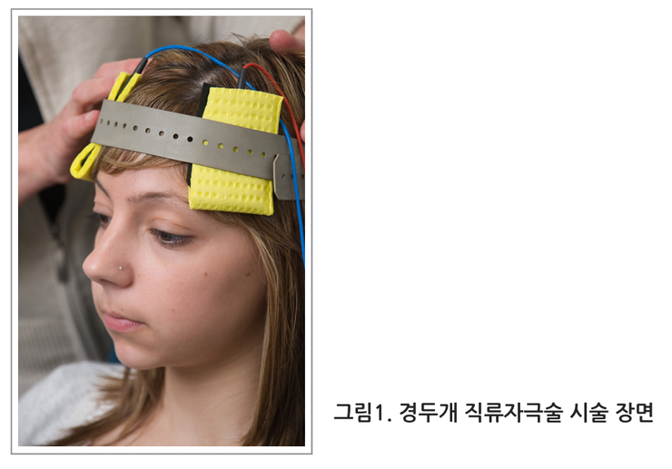 뇌자극술 2경두개 직류자극술이란 이재원 강남을지병원 정량뇌파 Brain Stimulation 학습장애adhd