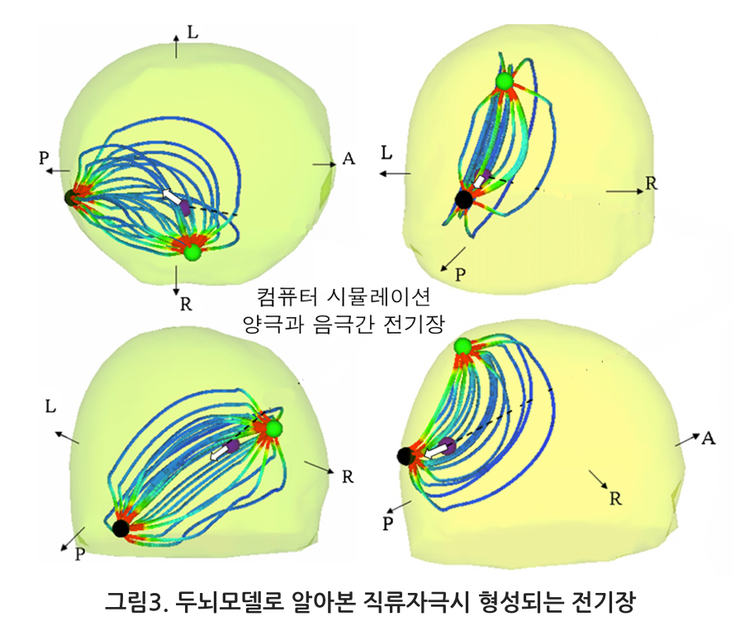 뇌자극술 2경두개 직류자극술이란 이재원 강남을지병원 정량뇌파 Brain Stimulation 학습장애adhd