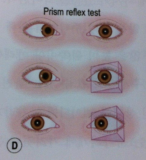 중심외주시(eccentric fixation)_ 허쉬버그검사(hirschberg test)_ 크림스키검사(Krimsky test ...