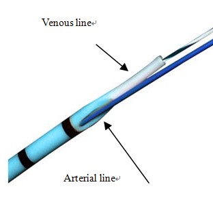 Arteriovenous access (AVF and AVG) : 네이버 블로그