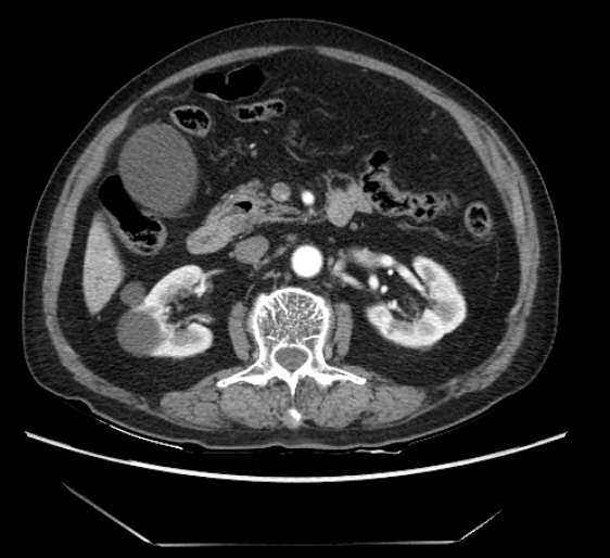 PTGBD (percutaneous transhepatic gallbladder drainage) : 네이버 블로그