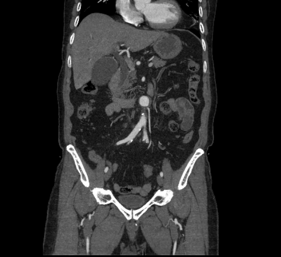 PTGBD (percutaneous transhepatic gallbladder drainage) : 네이버 블로그