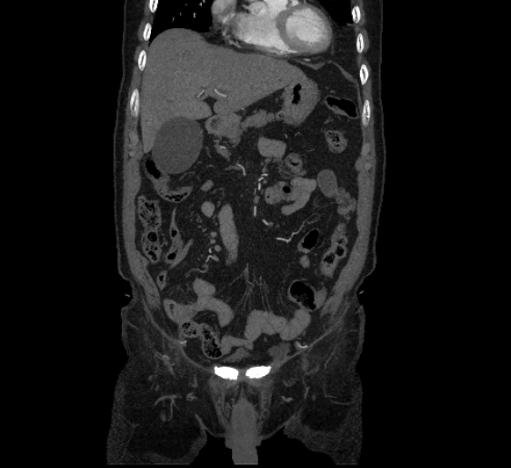 PTGBD (percutaneous transhepatic gallbladder drainage) : 네이버 블로그